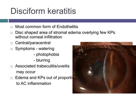 Viral Keratitis Diagnosis And Management Pptx