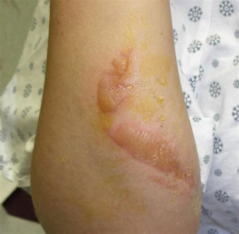 Concise Guidance National Primary Care Treatment And Referral Guidelines For Common Skin Conditions