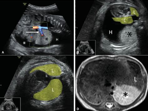 Bronchopulmonary Sequestration Treated Successfully With 54 Off