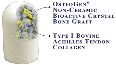 The Osteogen Plug One Step Bone Grafting Solution For Socket