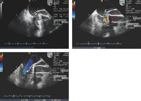 Prosthetic Valve Dysfunction Anesthesia Key