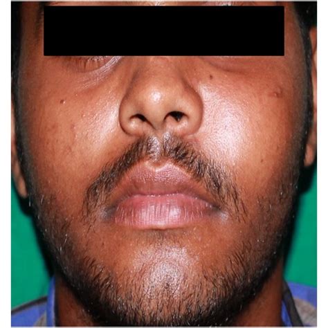 Pseudostratified Squamous Epithelium With Multiple Microcysts Hande 20x Download Scientific