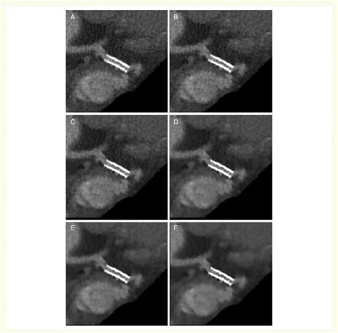 Oblique Ct Image Reconstruction Of A Left Circumflex Artery Stent At