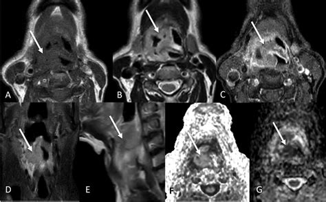 Transglottic Cancer Axial T1w T2w Post Contrast T1w