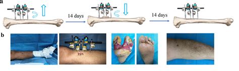 Figure 1 From Tibial Cortex Transverse Transport Facilitating Healing In Patients With