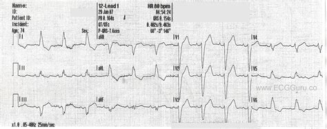 Left Bundle Branch Block Ecg Guru Instructor Resources