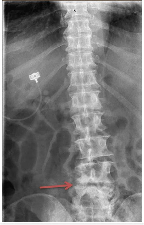 X Ray Of The Lumbar Spine Anteroposterior View Posterolisthesis Of Download Scientific