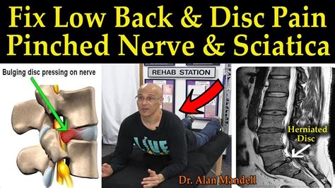 Slipped Disk Vs Pinched Nerve At Mary Eklund Blog