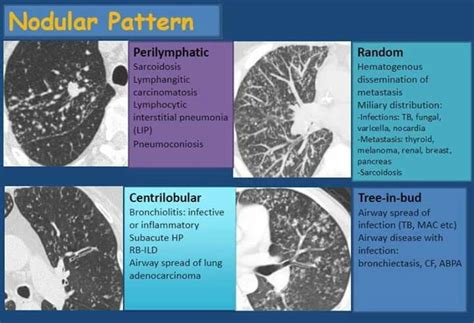 Tree In Bud Radiology Assistant Maynard Goetz