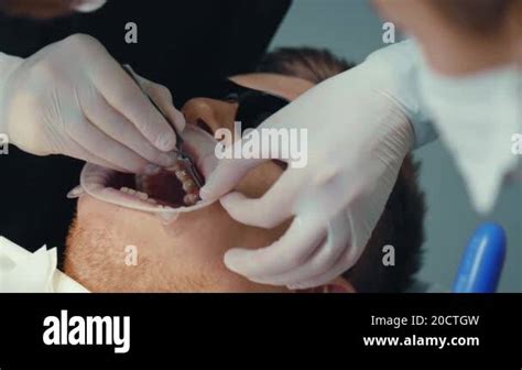 Dentist And Assistant With Special Tools Puts Braces To Man Mouth Teeth