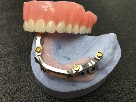 What Is The Difference Between Bar Overdenture And Locator Overdenture News Dentagama