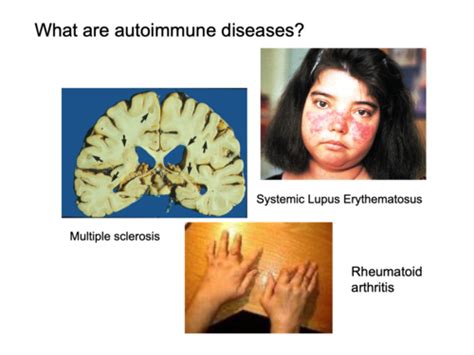 Autoimmunity Lecture 2 Flashcards Quizlet