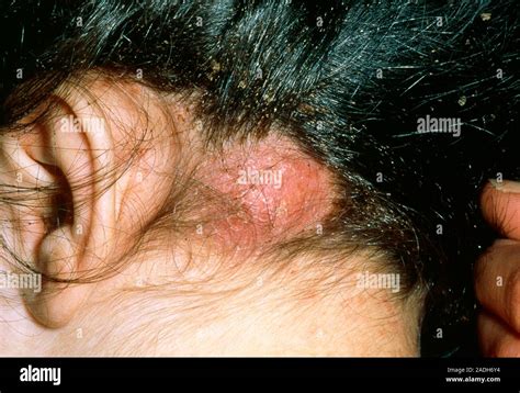 Abscess And Head Lice View Of An Abscess On The Scalp Of A Two Year Old Girl Heavily Infected