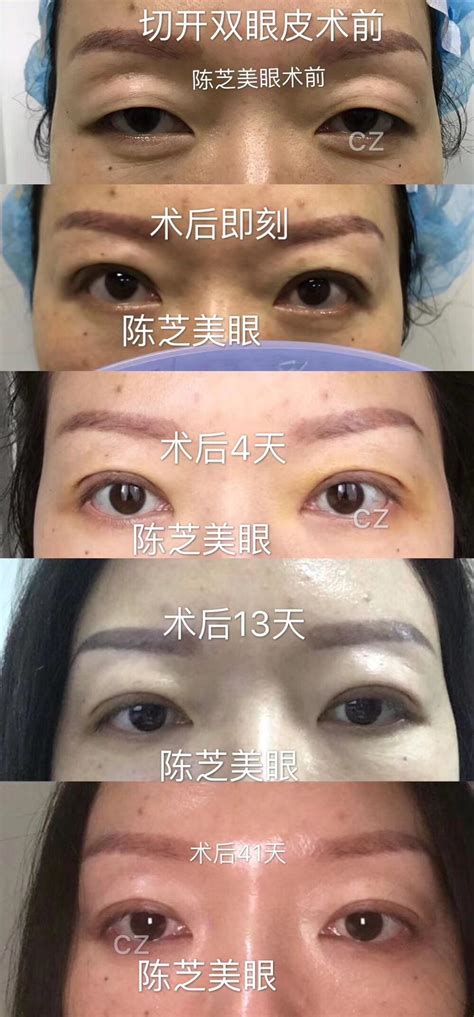常见双眼皮的方法介绍 知乎