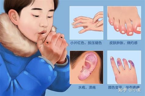 冻疮的病因和发病机制是什么 知乎