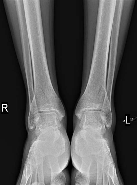 File Pilon Fracture Bilateral Radiopaedia 52423 58335 Frontal 1 