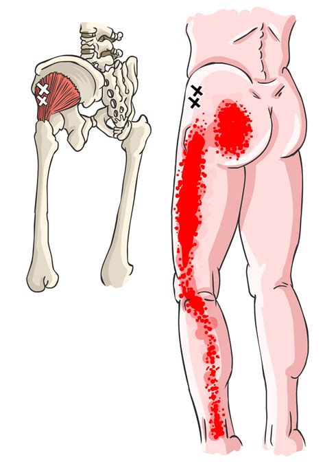 Gluteus Minimus Trigger Points