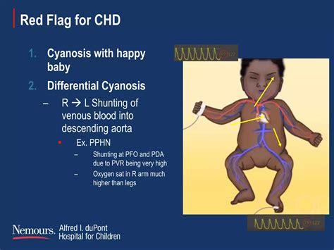 Approach To Cyanotic Chd Pptx