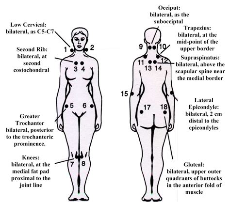 Fibromyalgia Trigger Points Alive Therapies