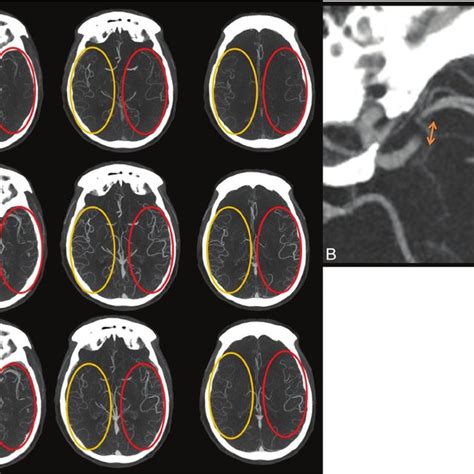 Measuring The Extent Of Revascularization Comparison Between The Tici Download Scientific