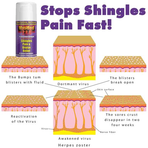 Topical Treatment For Shingles Lesions At Ian Milligan Blog