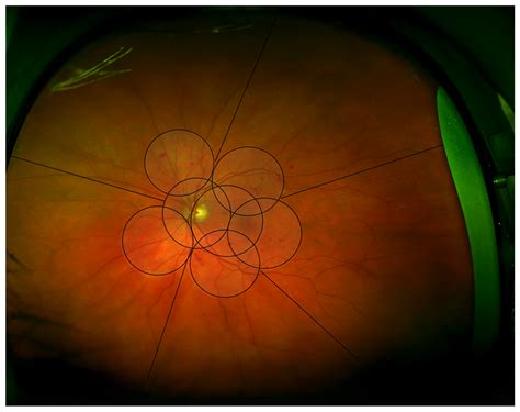 What Is Venous Beading In Diabetic Retinopathy At David Frakes Blog