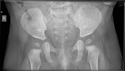 Normal Pelvis X Ray