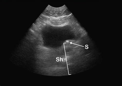 Bladder Bulge Unifying Old And New Sonographic Bladder Wall Abnormalities In Ureterolithiasis