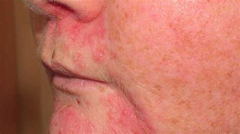 Signs Of Fatty Liver On Face Pictures And More