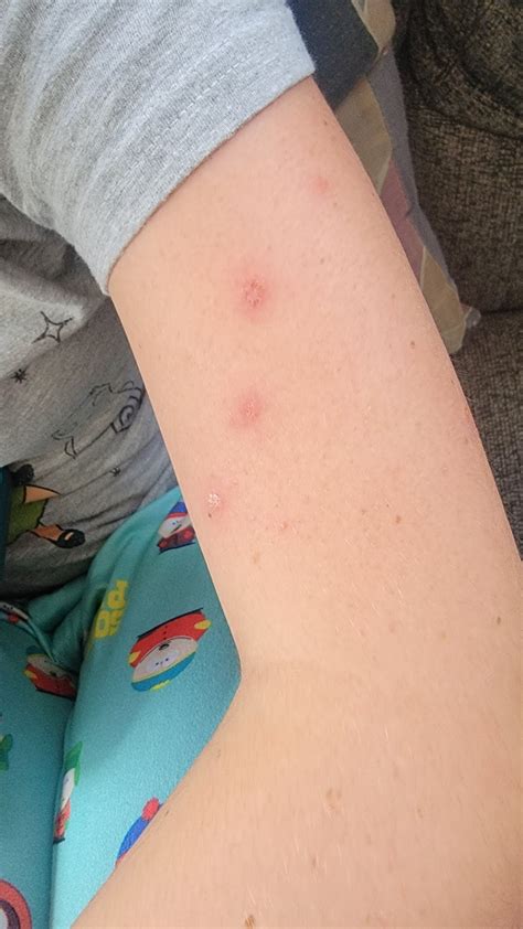 Bug Bite R Bugbites