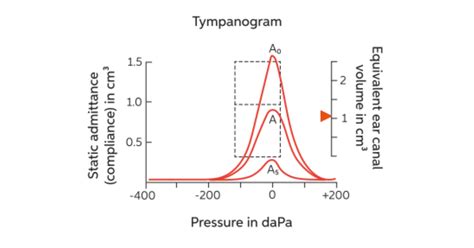 Otosclerosis Tympanogram
