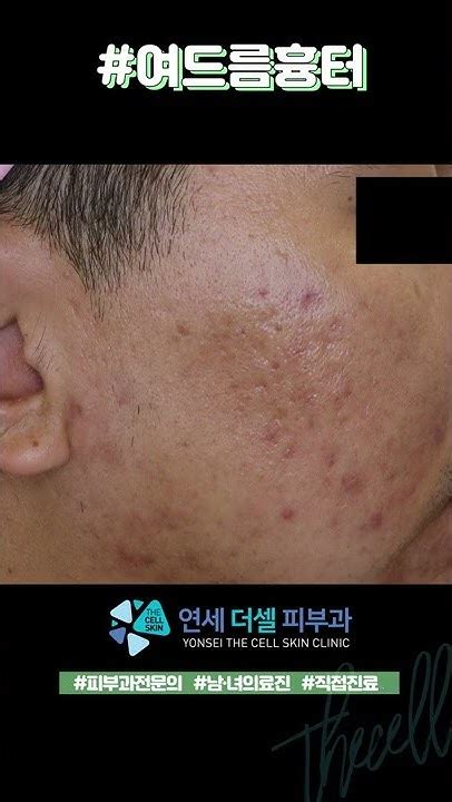 여드름흉터 없애는 법 여드름자국 여드름흉터치료 Shorts Youtube