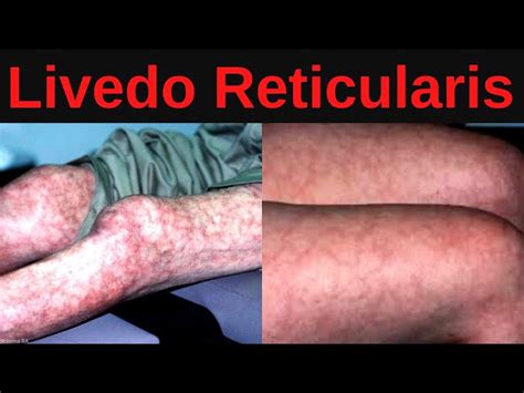 Mottled Foot
