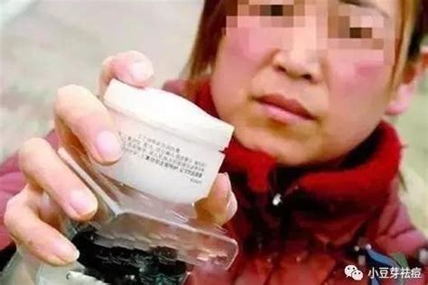 激素皮炎和化妆品皮炎之间有哪些区别