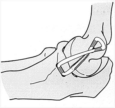 Ulnar Collateral Ligament Elbow Reconstruction