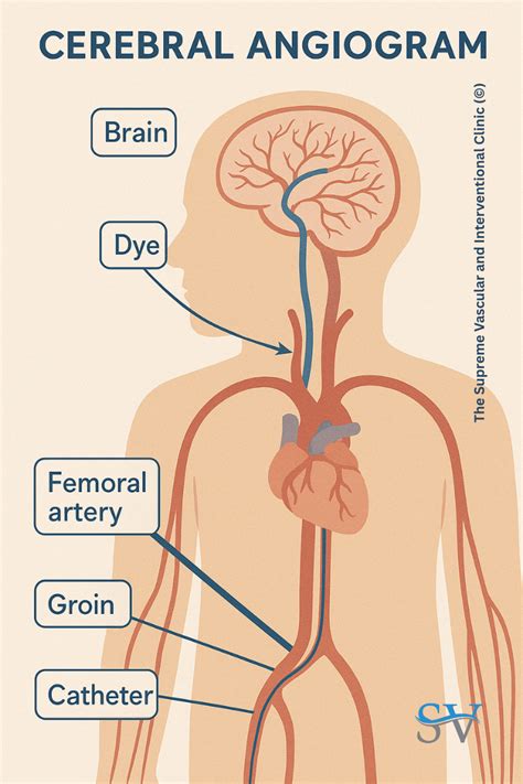 Understanding Cerebral Angiogram Recovery Supreme Vascular And Interventional Clinic