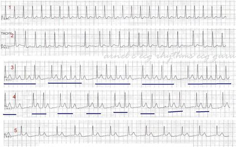 Ecg Challenge Grouped Beating Double Tachycardia Ecg Guru