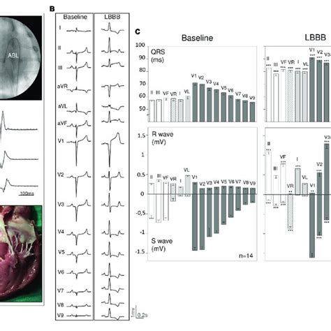 ECG Changes Induced By Min Occlusion Of The Left Circumflex LCX Download Scientific