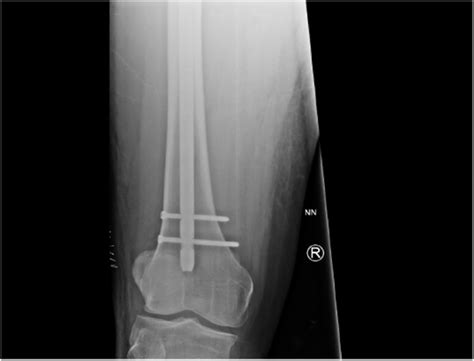 Day One Post Operative Radiographs Download Scientific Diagram