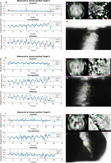 Markerless Real Time 3 Dimensional Kv Tracking Of Lung Tumors During Free Breathing Stereotactic
