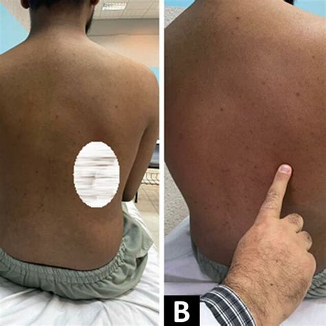 Murphys Sign Elicited By Naunyns Modified Technique Download