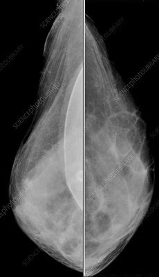 Mammogram Of Patient With Implants Stock Image C039 3386 Science Photo Library