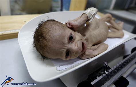 گرسنگی کودکان یمن عکس