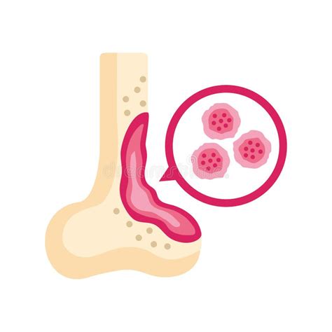 Sarcoma Bone Cancer Awareness Survivor Stock Illustration Illustration Of Awareness Isolated