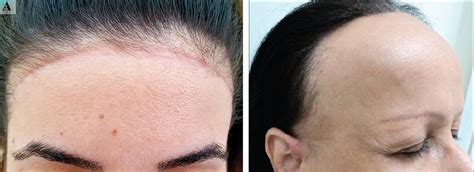 What Does A Normal Hairline Look Like Women