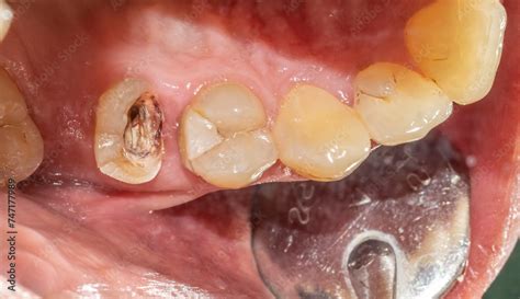 Maxillary Arch With Decayed Premolar Crown Half Destroyed Remaining