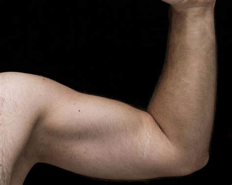 Dislocated Elbow 10 Dislocated Elbow Symptoms