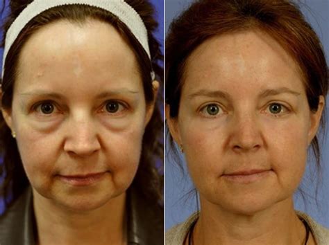 Festoons Treatment Under Eye Bag Surgery Dr Allan Wulc