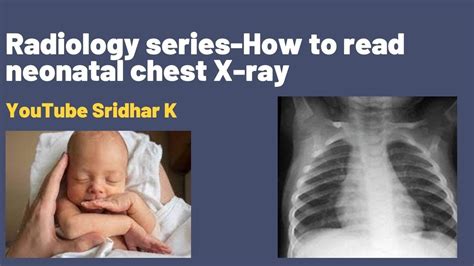 Neonatal Radiology How To Read Chest X Ray In Neonates The Basics Neonatalradiology X Ray