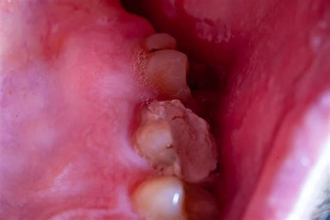Oral Mucositis Causes Symptoms And Advances In Treatment
